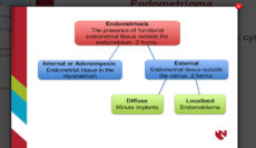 Endometrioma: A Female Reproductive System Pathology Case Study : E-Gallery