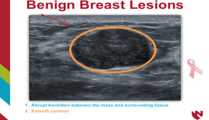Benign Breast Lesions: Breast Pathology Case Studies | E-Gallery ...