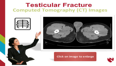 Testicular Fracture: A Male Reproductive System Case Study | E-Gallery ...