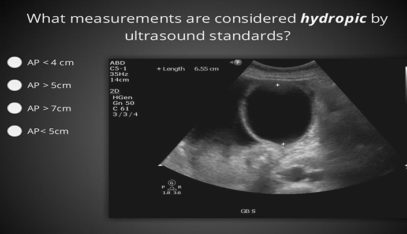Hydropic Gallbladder: A Biliary Tract Pathology Case Study | E-Gallery ...