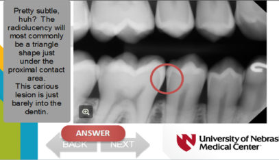 Radiographic Diagnosis of Dental Caries | E-Gallery | University of ...
