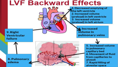 Left Heart Failure | E-Gallery | University of Nebraska Medical Center
