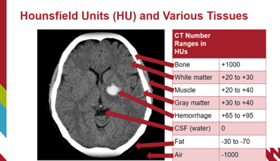 Approaching a Non-Contrast Head CT Scan: Excluding Intracranial ...