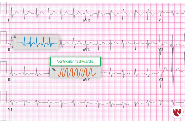 Mastering ECG Interpretation: A Systematic Approach to Arrhythmia ...