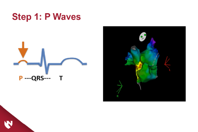 Mastering ECG Interpretation: A Systematic Approach to Arrhythmia ...