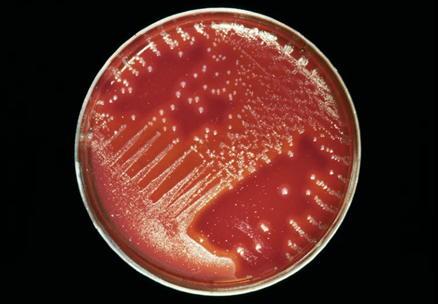 Why is strep A surging — and how worried are scientists? | The ...