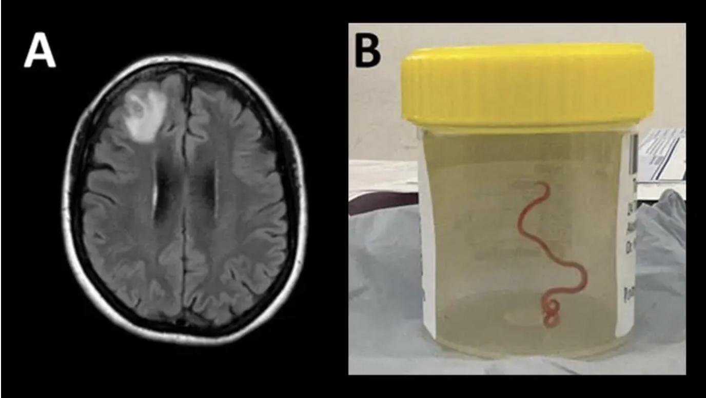 Live Worm Removed From Woman’s Brain | The Transmission | University of ...