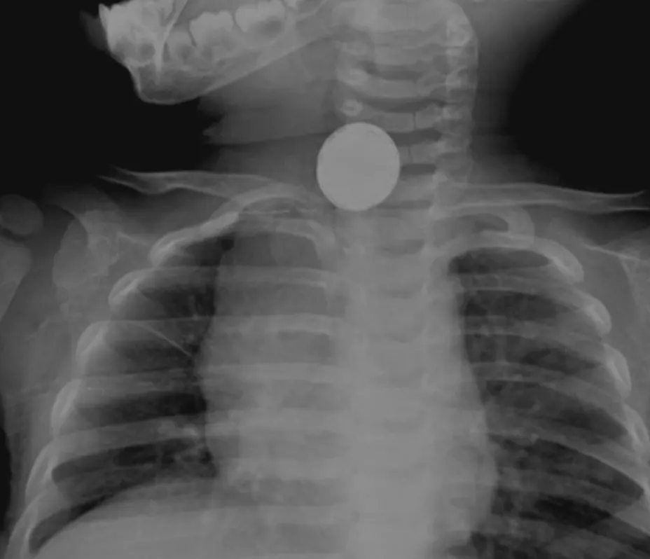 These are some of the strange objects that get stuck in people’s bodies ...