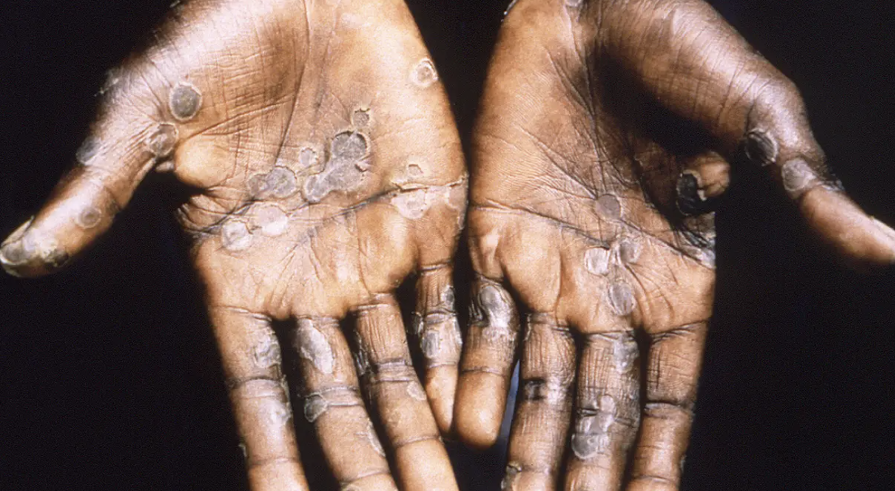 Is the New Mpox ‘Outbreak’ Deadlier? | The Transmission | University of ...