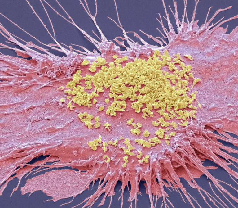 The Real Story Behind ‘White Lung Pneumonia’ | The Transmission ...